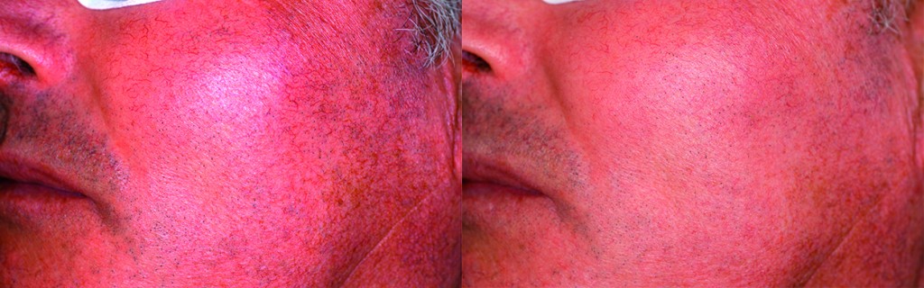 Treatment of telangiectatic rosacea | PRIME Journal