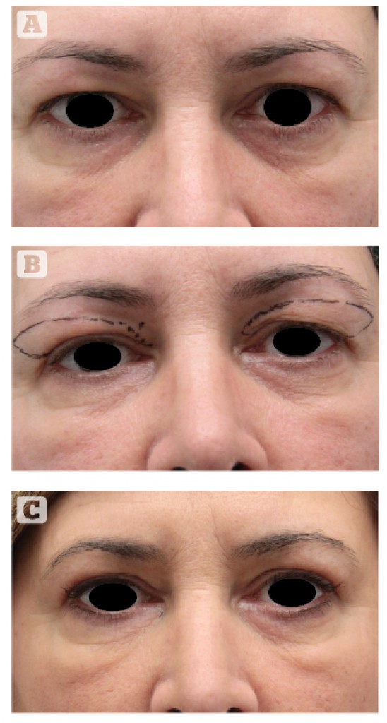Browpexy and upper blepharoplasty | PRIME Journal