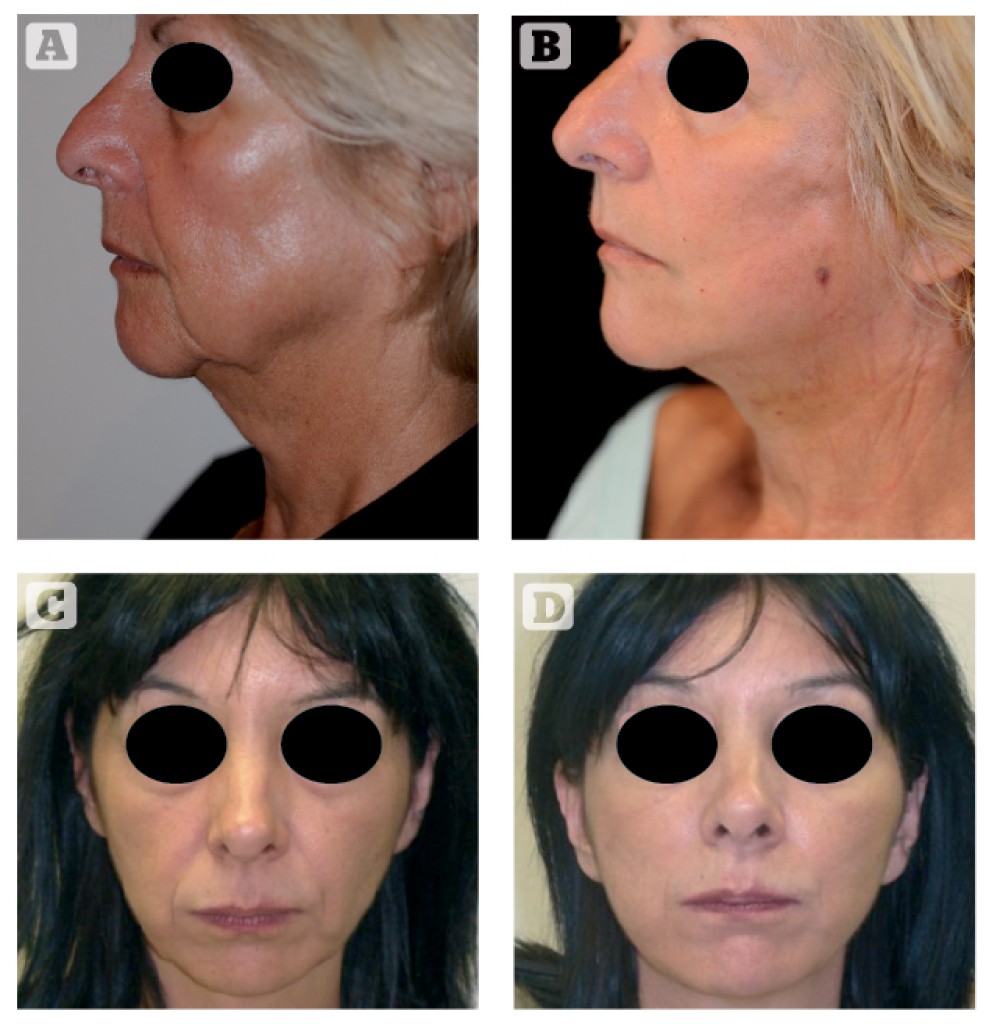 The use of suspension threads in facial rejuvenation | PRIME Journal