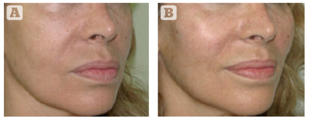 The use of suspension threads in facial rejuvenation | PRIME Journal