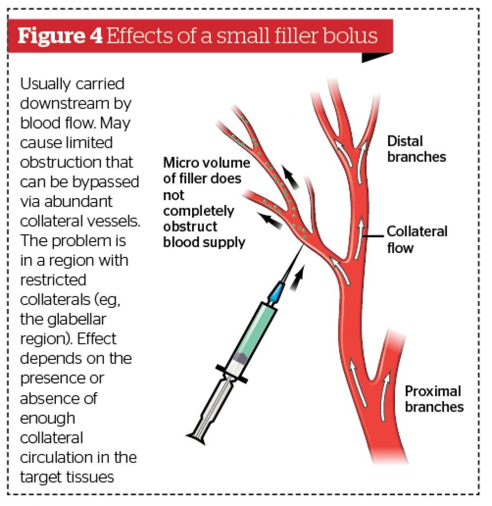 Reversal of a dermal filler induced facial artery occlusion | PRIME Journal