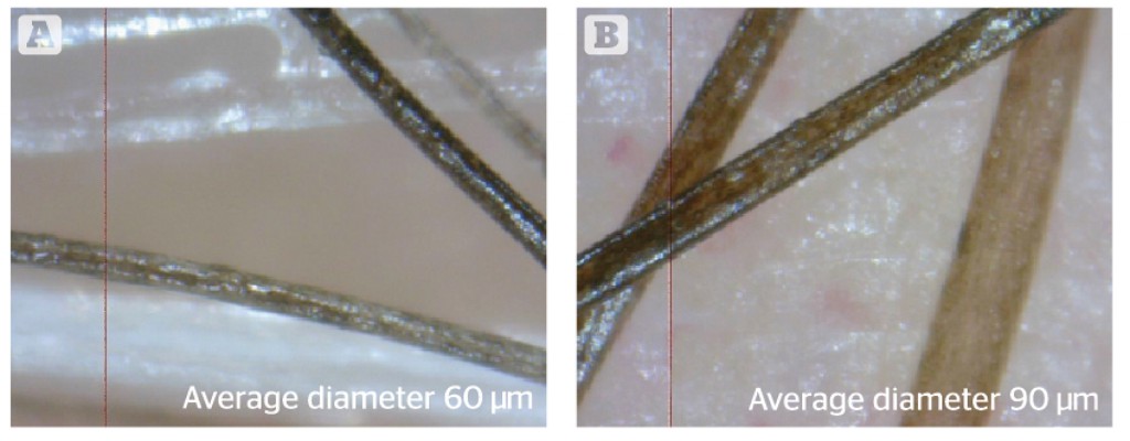 A polynucleotide-based product to treat female hormonal hair loss ...