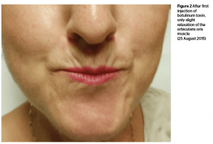 Lip rejuvenation for a patient with Systemic Scleroderma | PRIME Journal