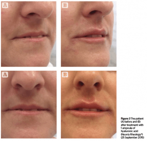 Lip rejuvenation for a patient with Systemic Scleroderma | PRIME Journal