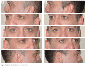 Treating the periorbital region | PRIME Journal