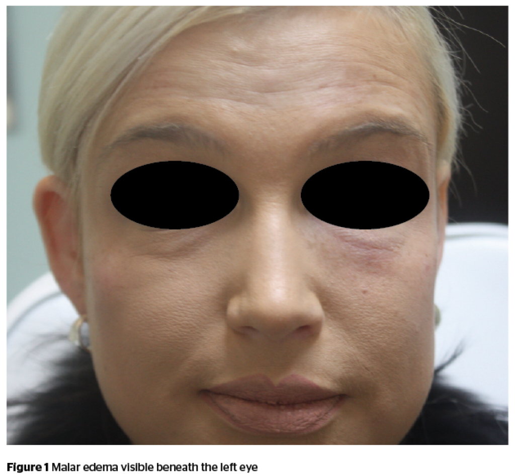 Dermal fillers – All the things that can go wrong | PRIME Journal