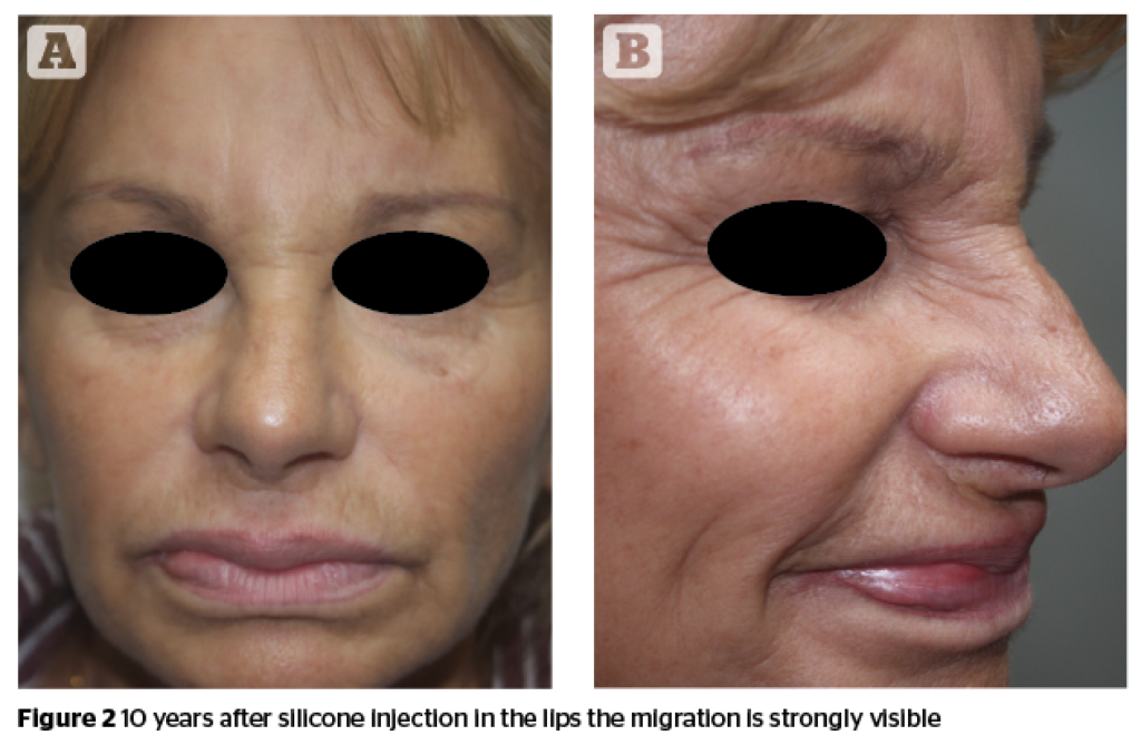 Dermal fillers – All the things that can go wrong | PRIME Journal