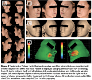 Facial overfilled syndrome complications of inappropriate filler ...