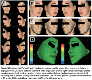 Facial overfilled syndrome complications of inappropriate filler ...