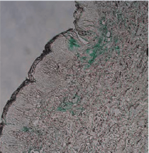 The Next Evolution in Chemical Peeling Post Microneedling Treatment ...