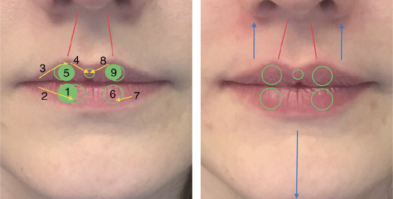 The non-surgical lip lift with tubercle shifts | PRIME Journal