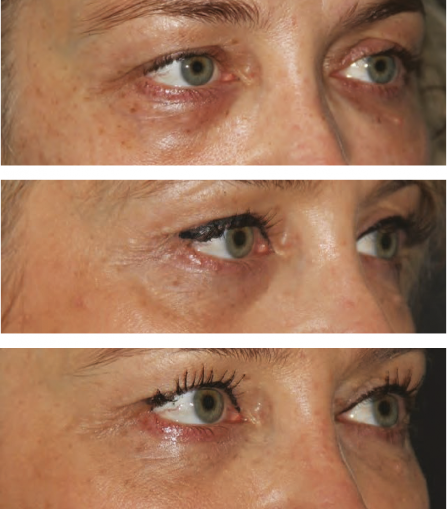 Filler Injections Prevention and Treatment of Complications | PRIME Journal