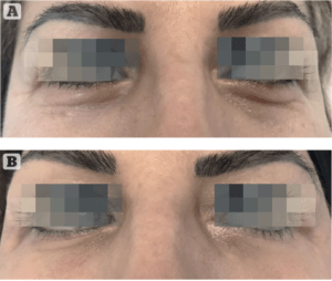 EYE CONTOUR DARK CIRCLES, WRINKLES AND BAGS | PRIME Journal