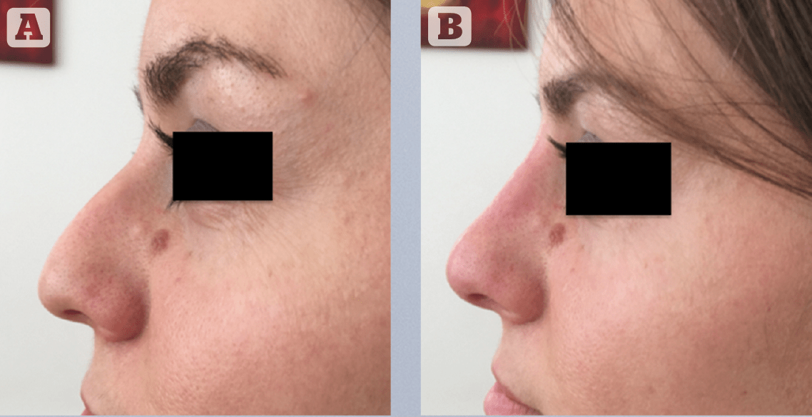 Medical Rhinoplasty | PRIME Journal