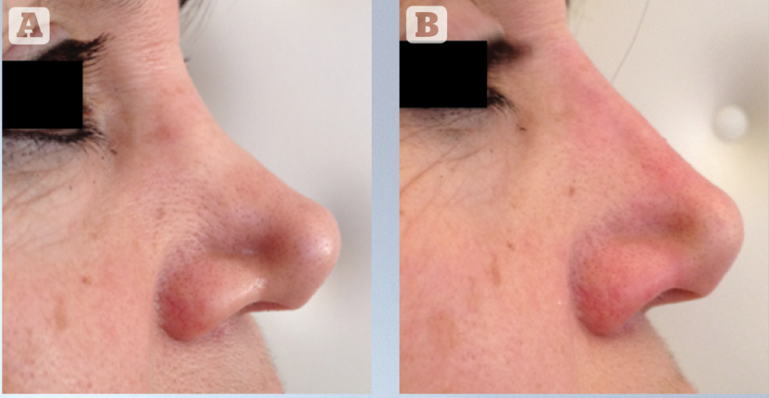 Medical Rhinoplasty | PRIME Journal
