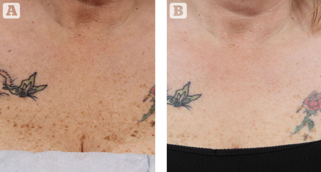 Light and Bright™ treatment of photodamaged skin and textural ...