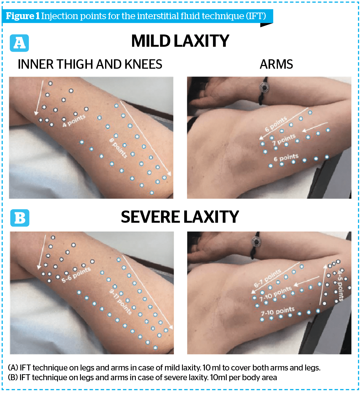 Skin Laxity: A New Intradermal Injective Treatment | PRIME Journal