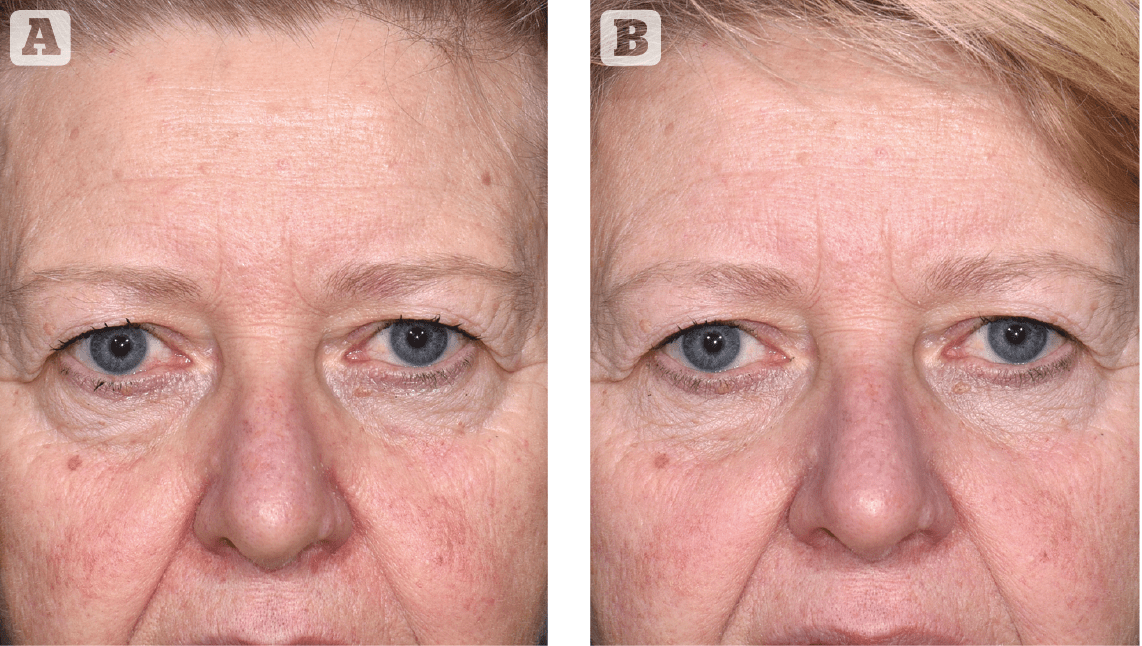 Where are we going with volumising injections? | PRIME Journal