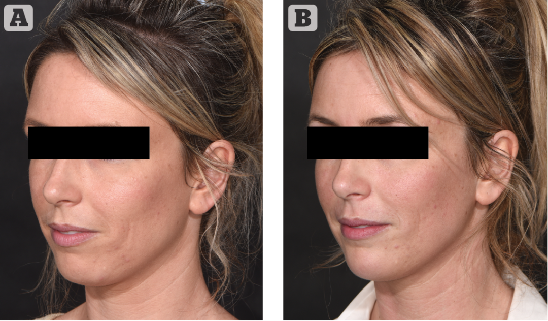 Where are we going with volumising injections? | PRIME Journal