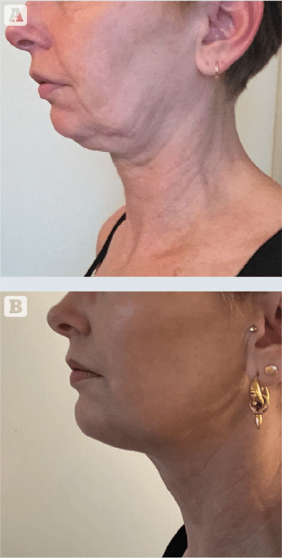 Neck Rejuvenation with HA Fillers, Toxin and HA Hybrid Complexes ...