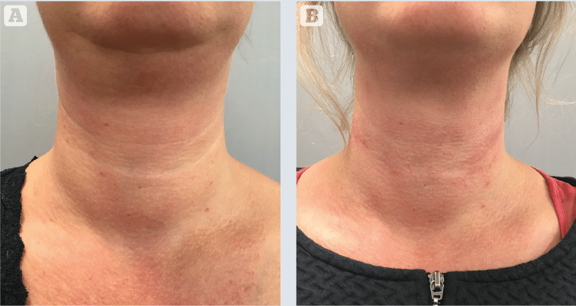 Neck Rejuvenation with HA Fillers, Toxin and HA Hybrid Complexes ...