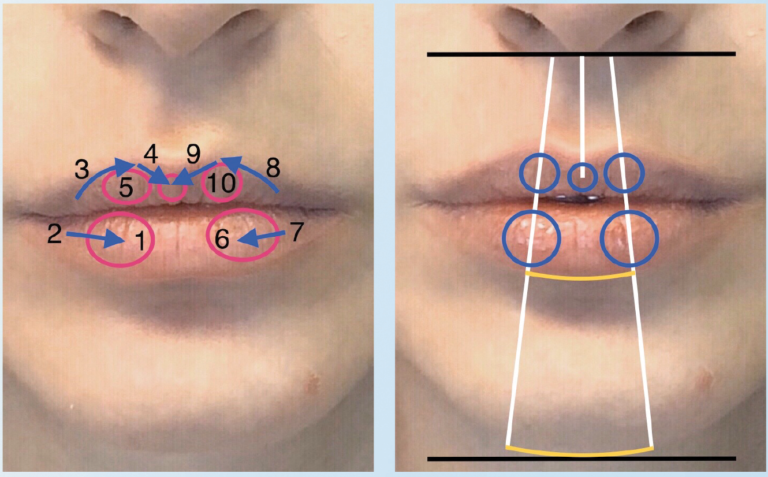 The Non-surgical Lip Lift (NLL) with tubercle shifts, H-Lines and H ...
