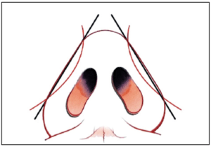 A Novel New Technique for lower Lateral Cartilage Concavity | PRIME Journal