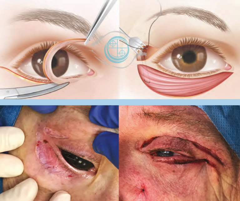 DUAL PLANE LOWER BLEPHAROPLASTY WITH THE ‘EYELID LIFT’ | PRIME Journal