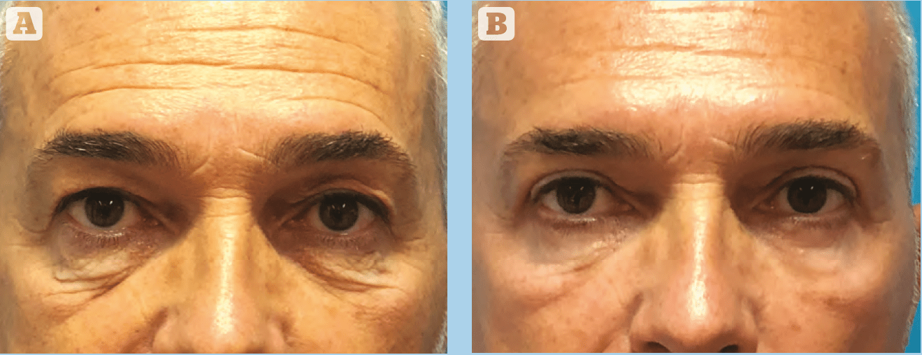 DUAL PLANE LOWER BLEPHAROPLASTY WITH THE ‘EYELID LIFT’ | PRIME Journal