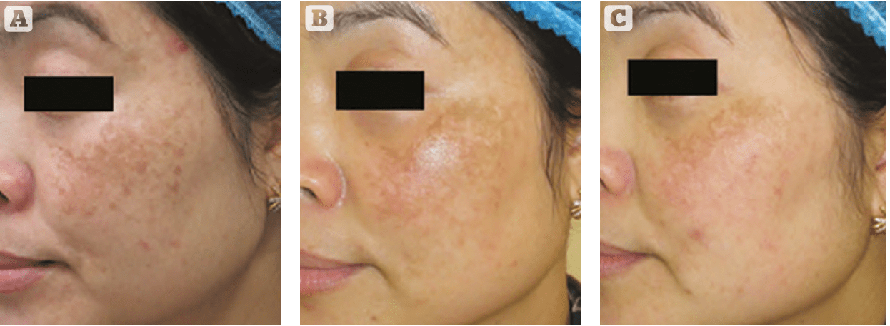 BREAKTHROUGH IN REFRACTORY MELASMA USING FRACTIONAL MICRONEEDLING RF ...