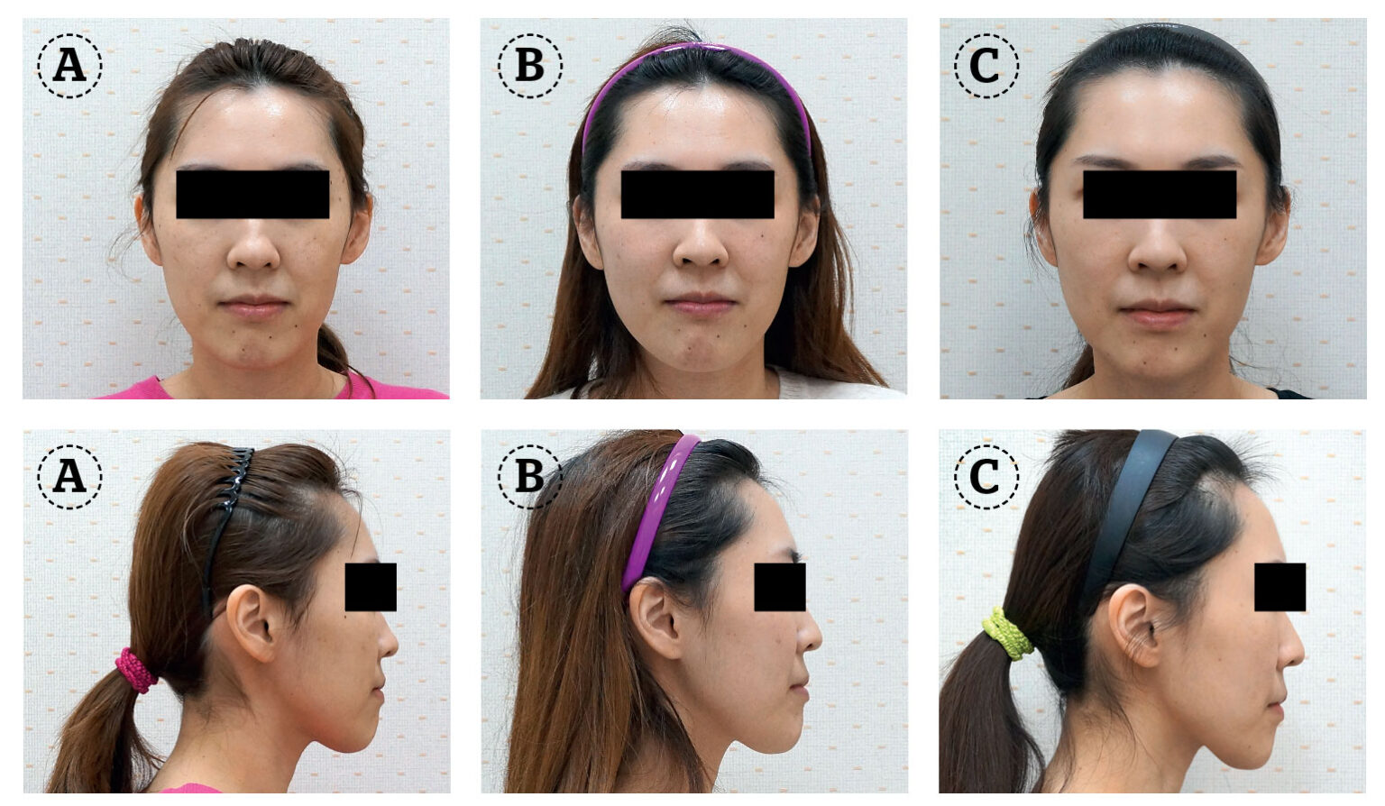 Perioral Myomodulation with Filler Injection | PRIME Journal