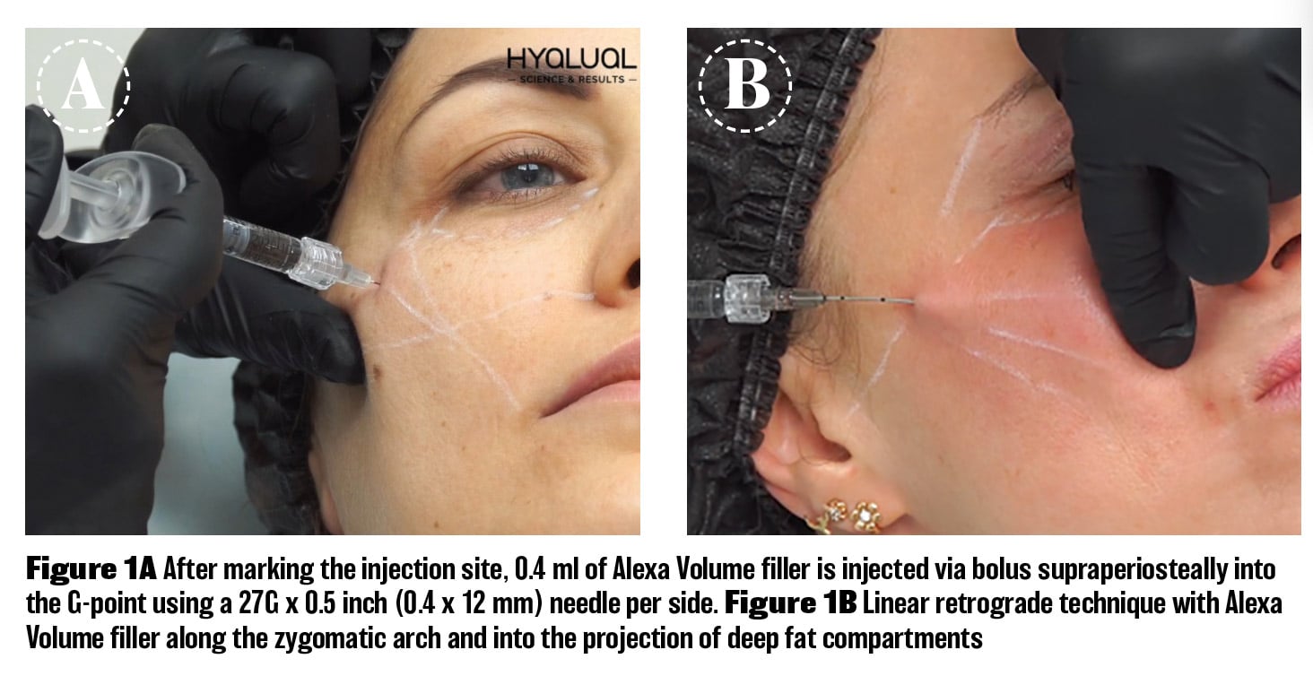 Injectable Treatments for the Under-Eye Area: Challenges and ...
