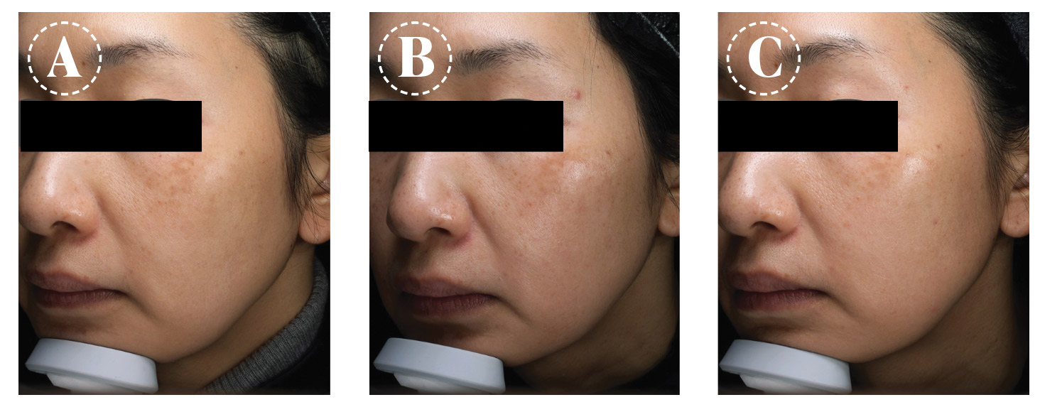 Smart Skin Synergy: Pairing Mesotherapy with Energy Devices | PRIME Journal